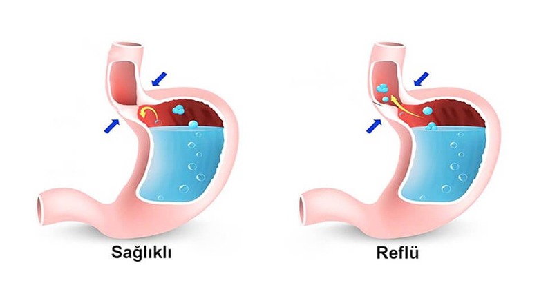 GERDX; Reflü Sorununa İlaçsız ve Ameliyatsız Çözüm - Acıbadem Hemşirelik
